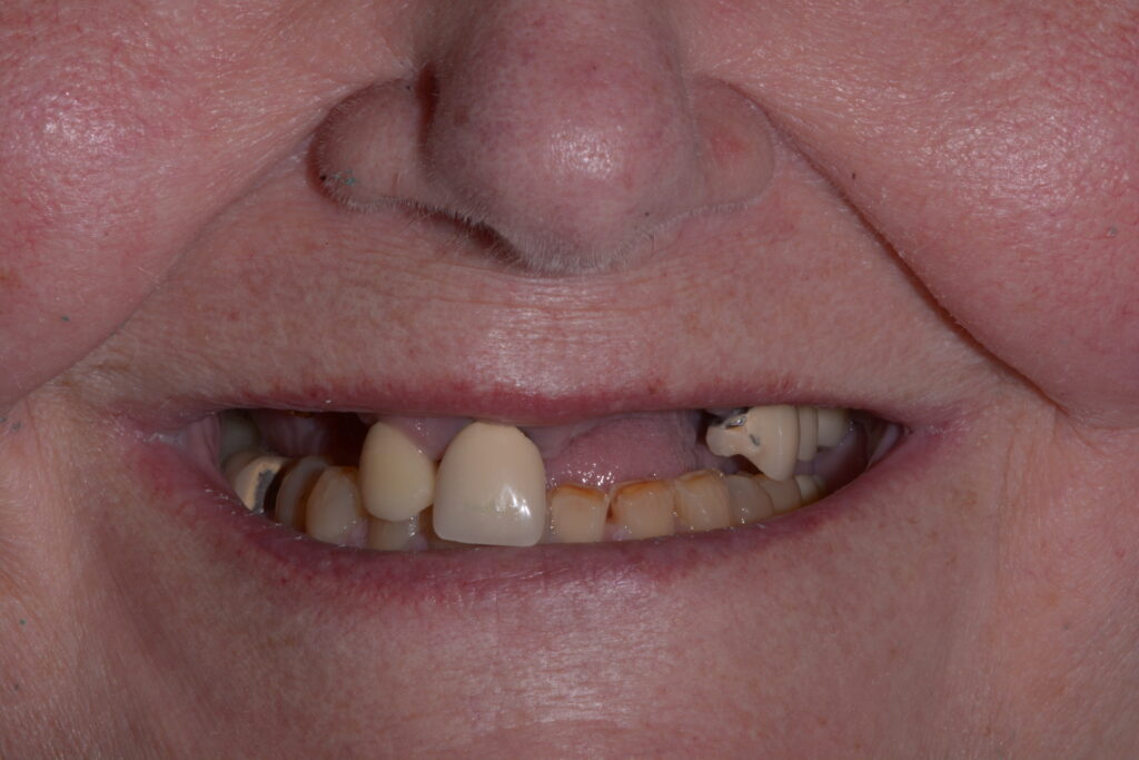 Dental Implants Before and After